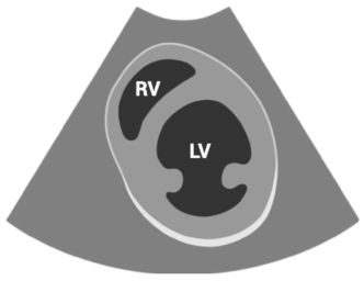 Echo basics: Parasternal Views • LITFL • Radiology Library