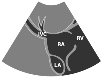 Echo basics: Apical and Subcostal Views • LITFL • Radiology Library