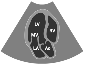 Echo basics: Apical and Subcostal Views • LITFL • Radiology Library