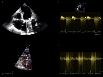 Echo basics: Tips and Tricks • LITFL • Radiology Library