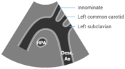 Echo basics: Apical and Subcostal Views • LITFL • Radiology Library