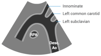 Echo basics: Apical and Subcostal Views • LITFL • Radiology Library