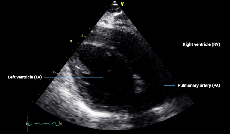 Echo basics: Parasternal Views • LITFL • Radiology Library