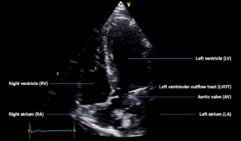 Echo basics: Apical and Subcostal Views • LITFL • Radiology Library