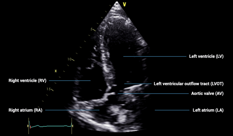 Echo basics: Apical and Subcostal Views • LITFL • Radiology Library