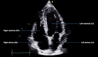 Echo basics: Apical and Subcostal Views • LITFL • Radiology Library