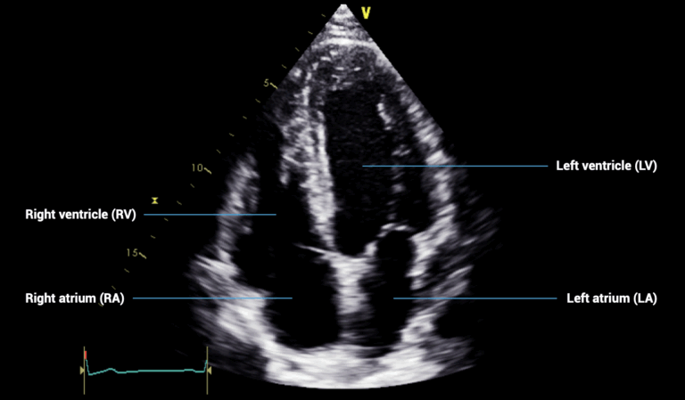 Echo basics: Apical and Subcostal Views • LITFL • Radiology Library