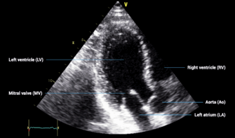 Echo basics: Apical and Subcostal Views • LITFL • Radiology Library