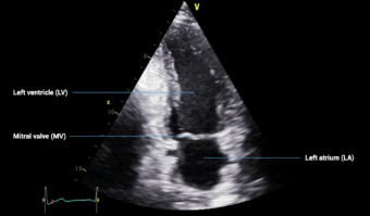 Echo basics: Apical and Subcostal Views • LITFL • Radiology Library