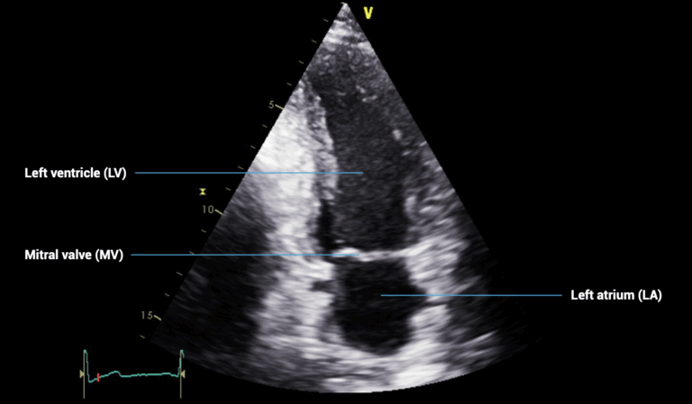 Echo basics: Apical and Subcostal Views • LITFL • Radiology Library
