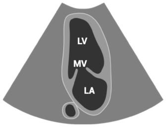 Echo basics: Apical and Subcostal Views • LITFL • Radiology Library