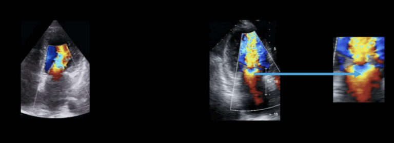 Echo basics: Mitral Stenosis • LITFL • Radiology Library