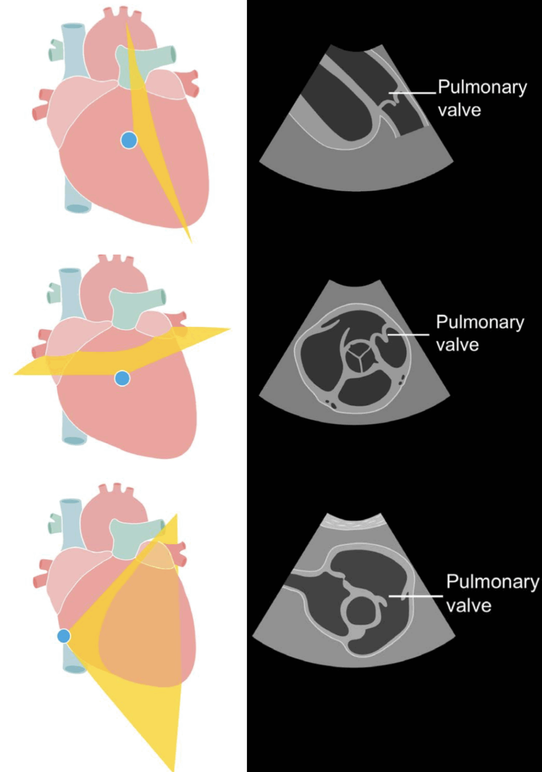Echo basics: Pulmonary Valve • LITFL • Radiology Library