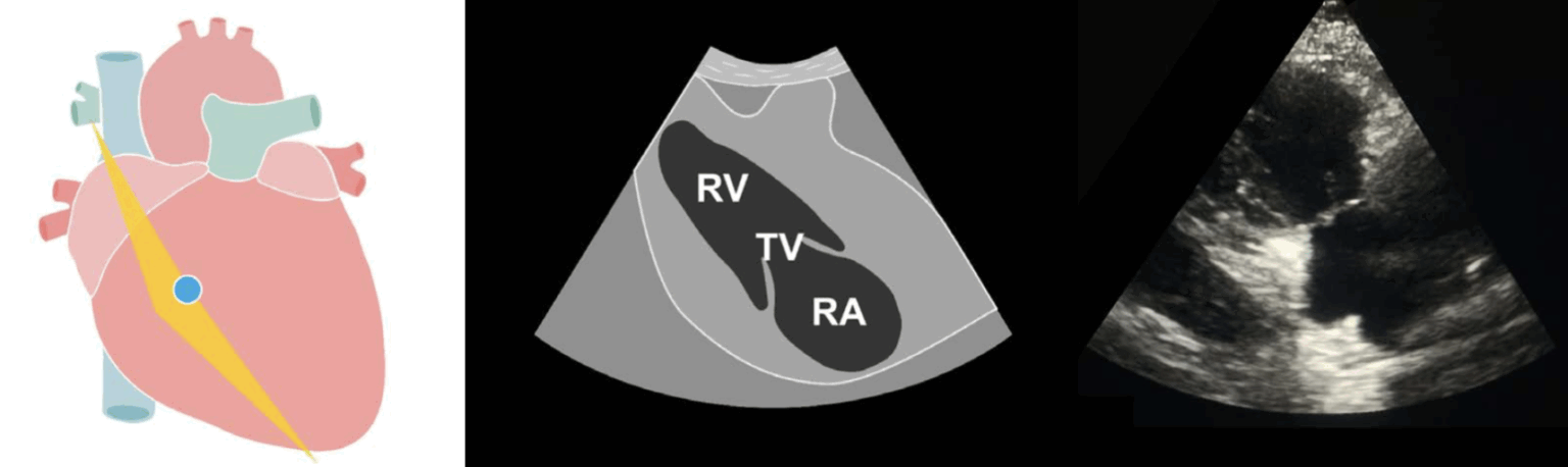 Echo basics: Tricuspid Valve • LITFL • Radiology Library