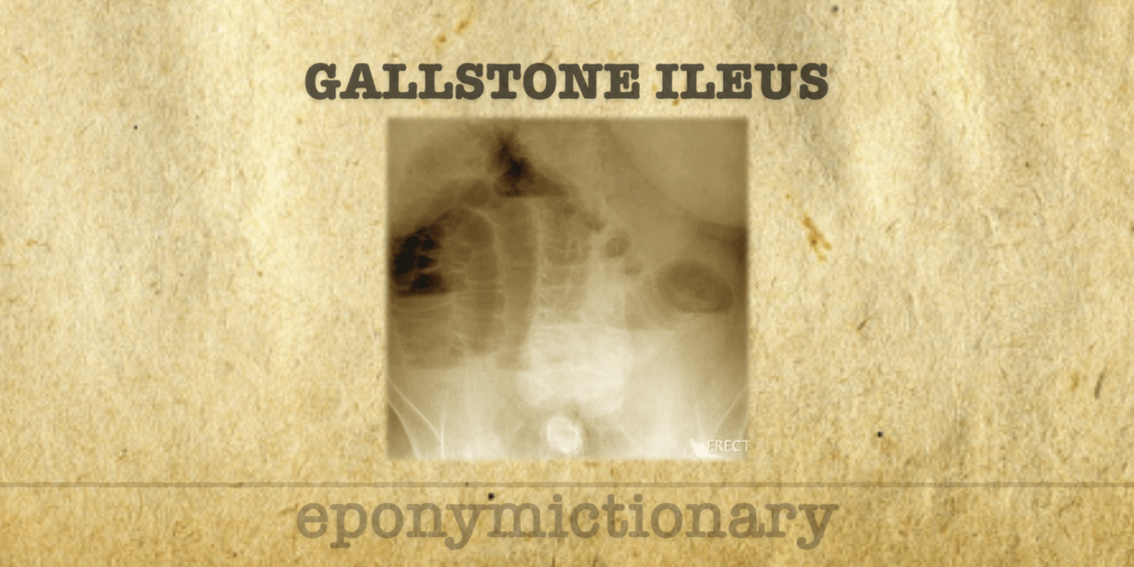 History of the gallstone ileus • LITFL • Medical Eponym Library