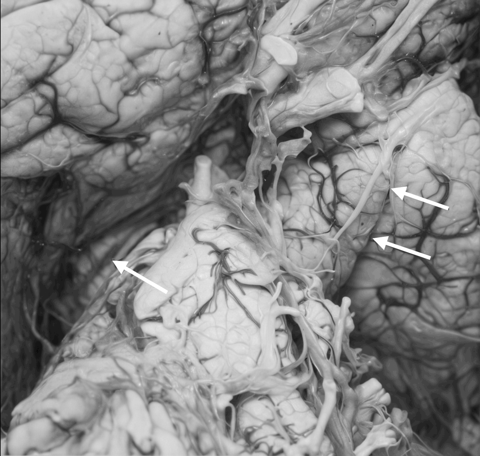 Kernohan-Woltman Notch Phenomenon • LITFL