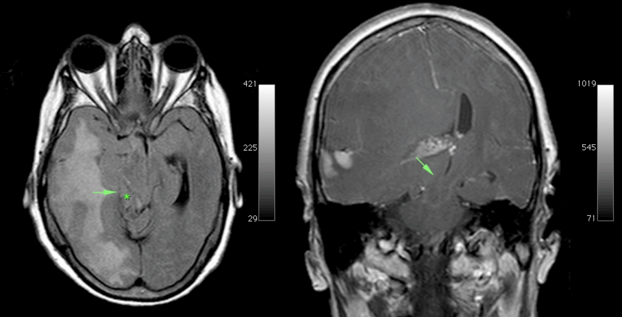 Kernohan-Woltman Notch Phenomenon • LITFL