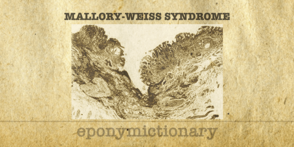 Mallory-Weiss syndrome • LITFL • Medical Eponym Library