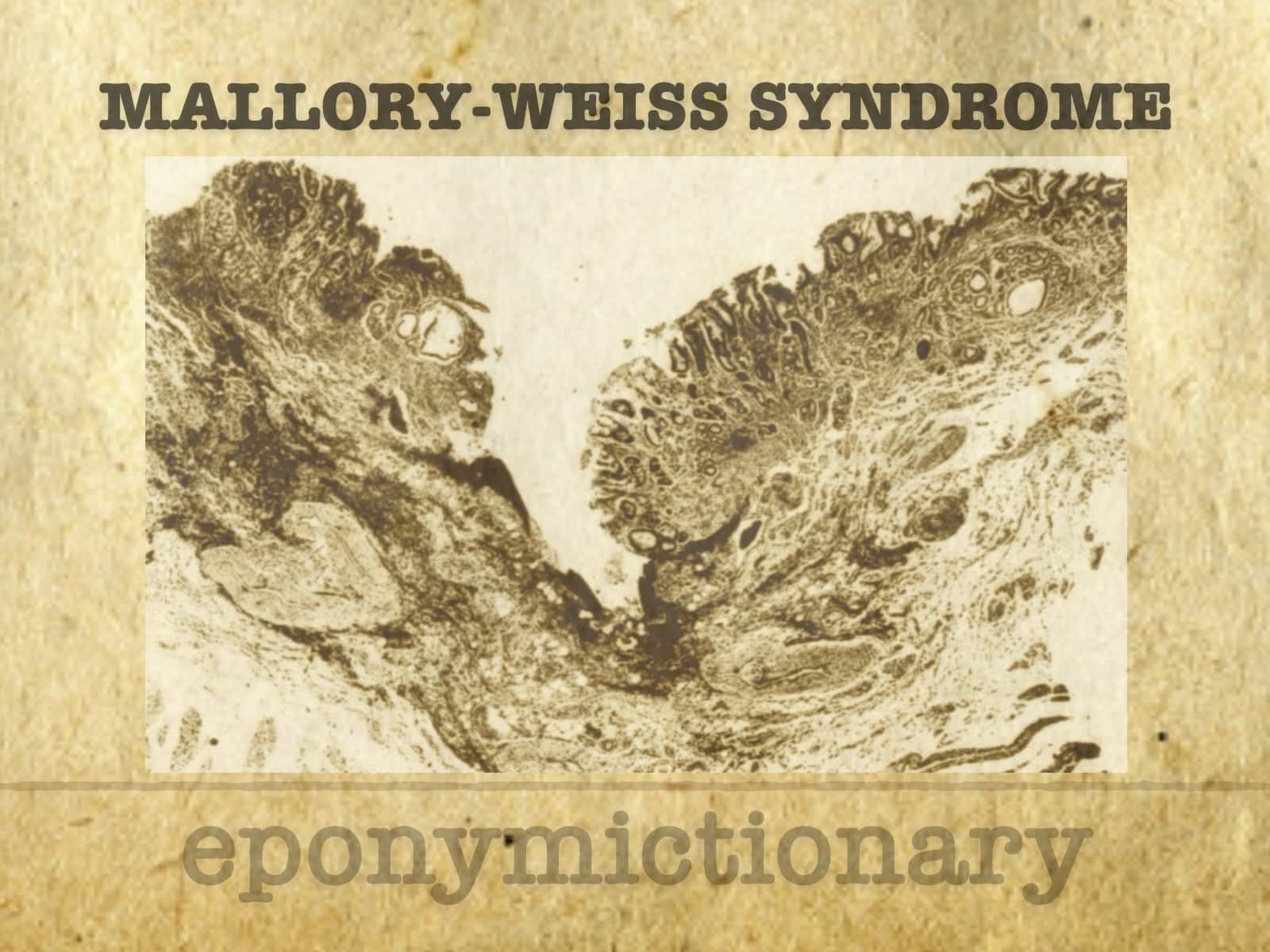 Mallory–Weiss tear Archives • LITFL
