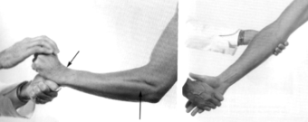 Radial Nerve Lesions • LITFL • FFS