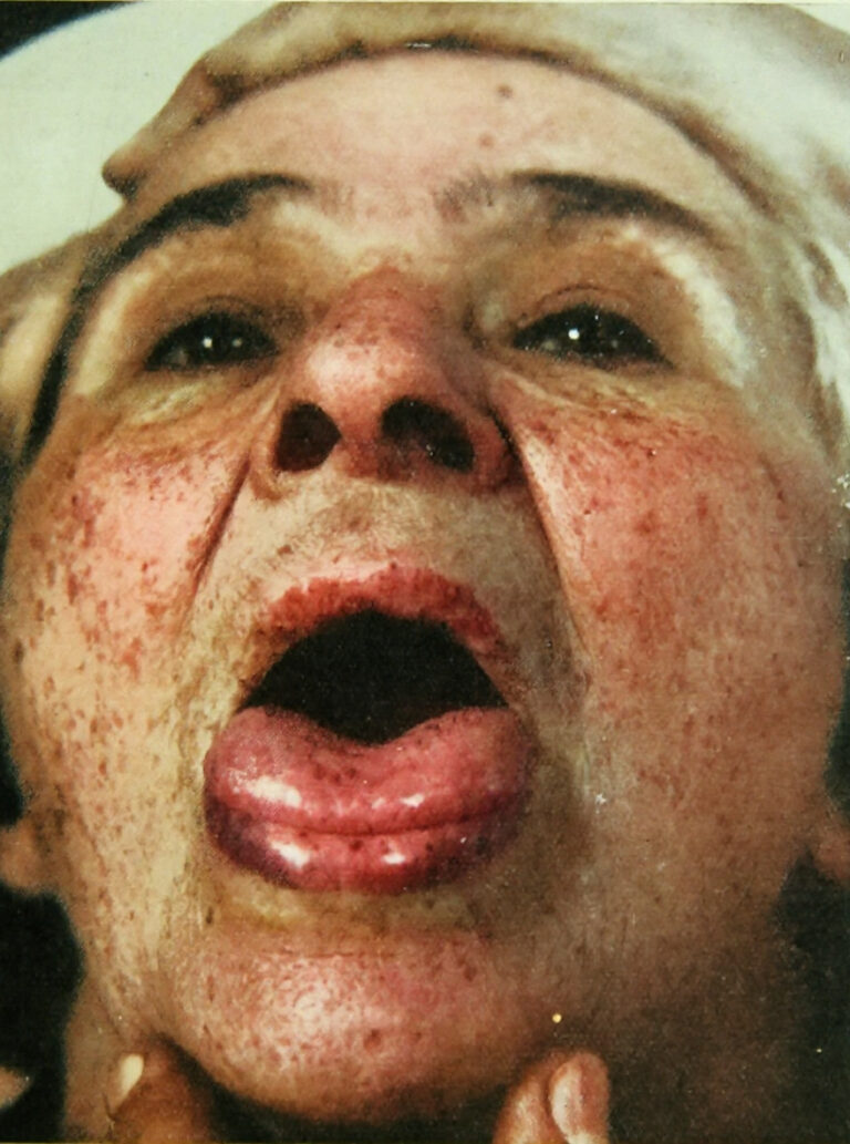 Rendu-Osler-Weber disease • LITFL • Medical Eponym Library