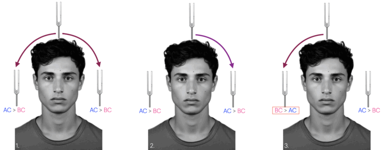 Tuning Fork Tests (Weber and Rinne) • LITFL • Eponymictionary