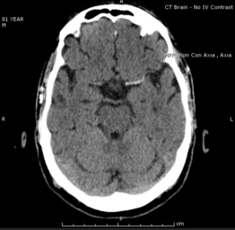 Stroke Infarction: Anterior Circulation • LITFL • FFS