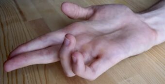 Ulnar Nerve Lesions • LITFL • FFS