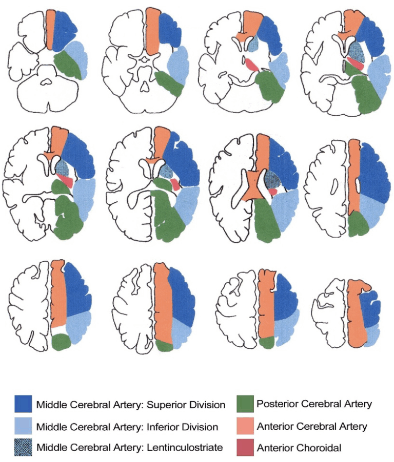 Stroke Infarction: Clot Retrieval • LITFL • FFS
