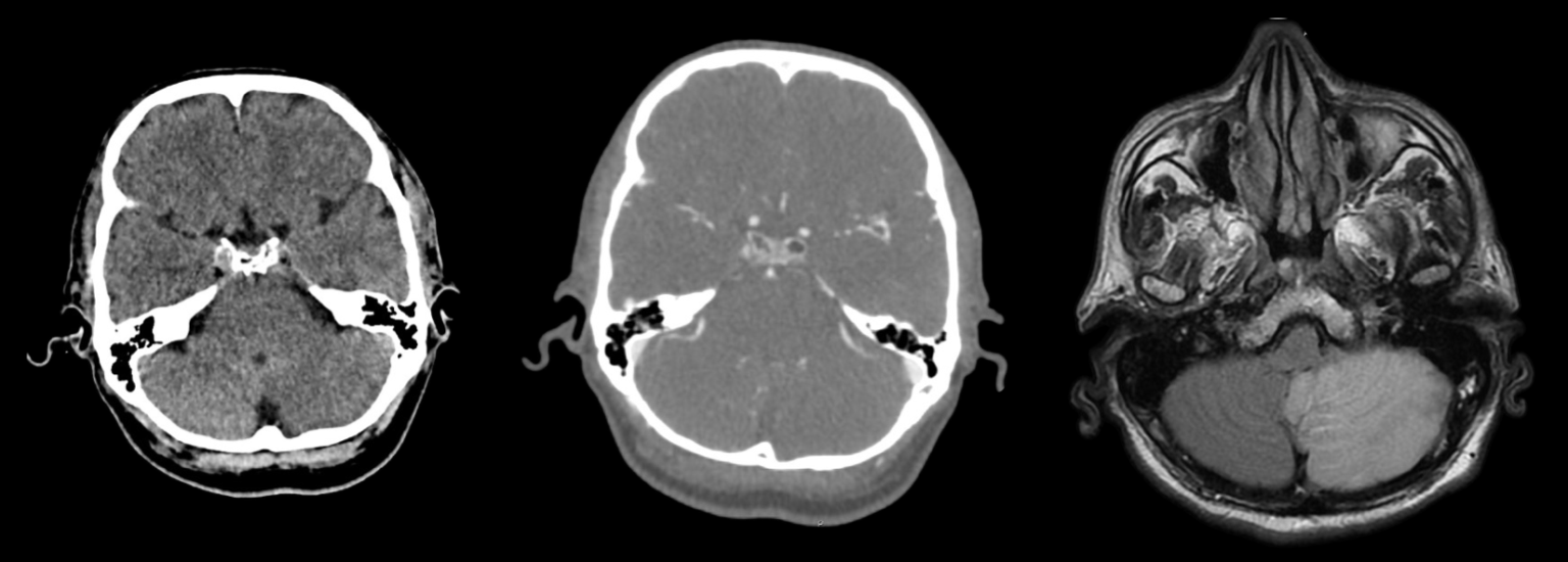 Stroke Infarction: Posterior Circulation • LITFL • FFS
