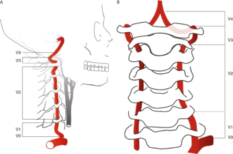 Stroke Infarction: Posterior Circulation • LITFL • FFS