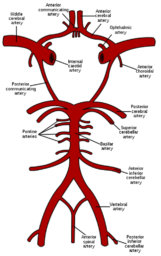 Stroke Infarction: Basilar Artery • LITFL • FFS