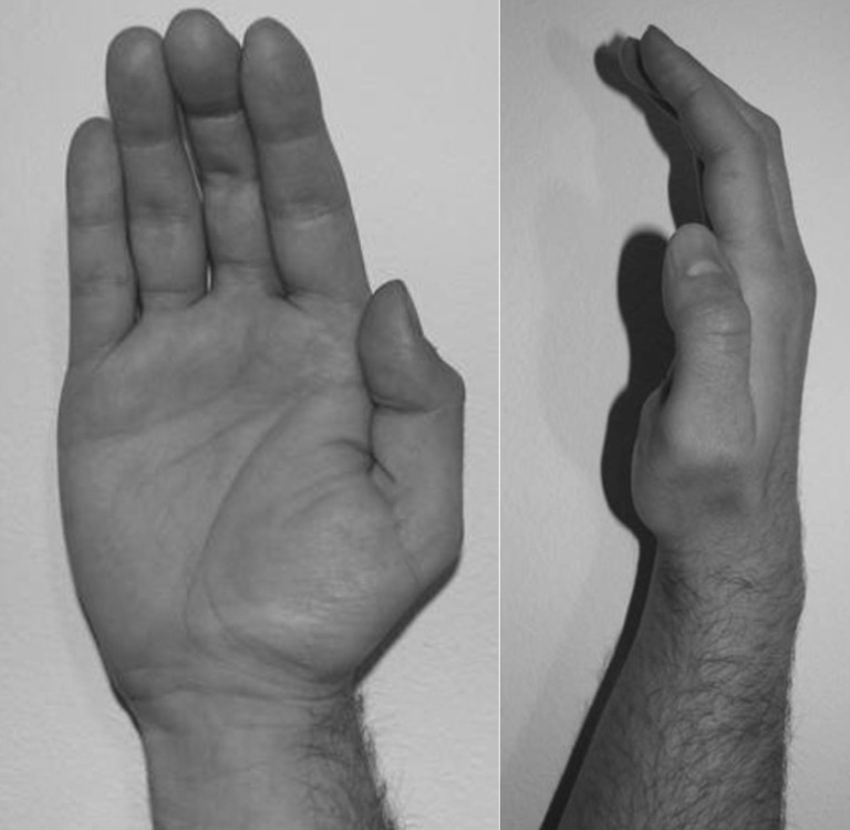 Median Nerve Lesions • LITFL • FFS