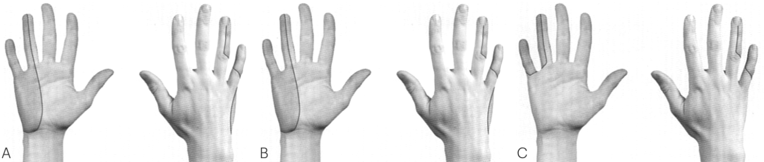 Ulnar Nerve Lesions • LITFL • FFS