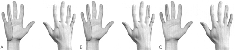 Ulnar Nerve Lesions • LITFL • FFS