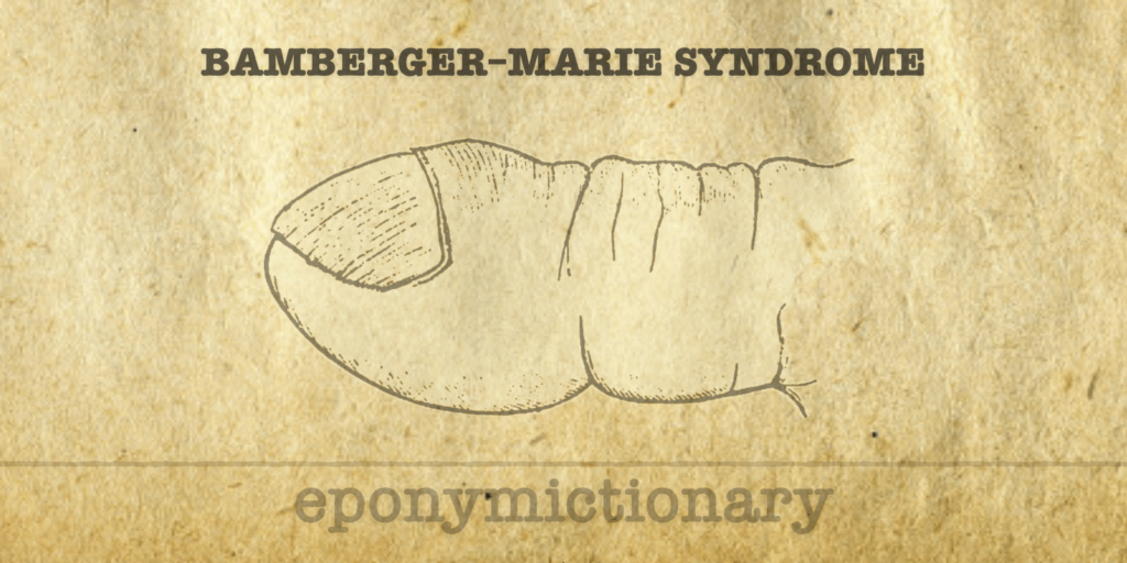 Bamberger–Marie syndrome • LITFL • Medical Eponym Library