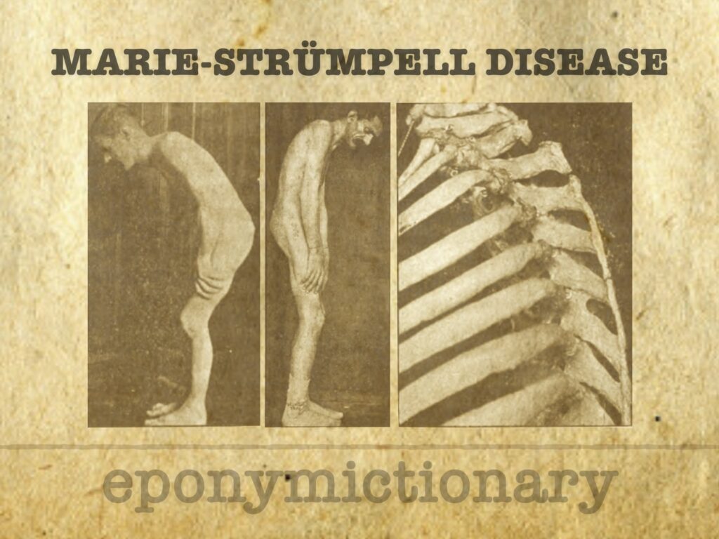 marie-strumpell disease Archives • LITFL