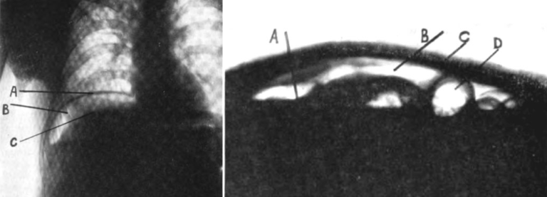Rigler sign • LITFL • Medical Eponym Library