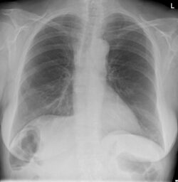 Chilaiditi syndrome • LITFL • Medical Eponym Library
