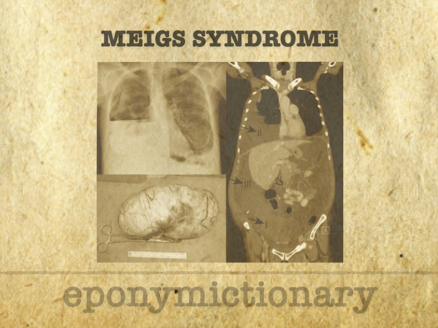 Demons–Meigs Syndrome Archives • LITFL