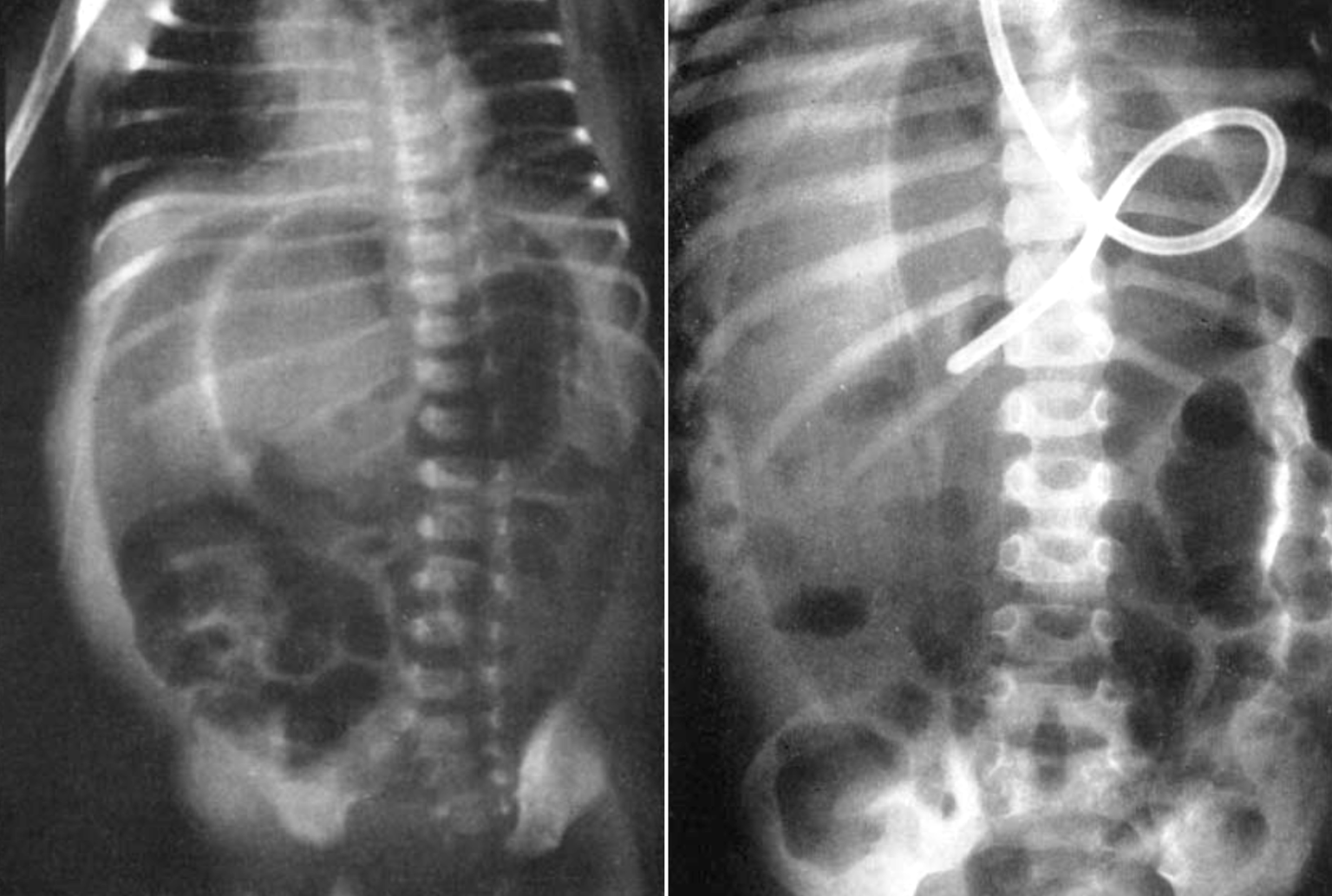 Rigler sign • LITFL • Medical Eponym Library