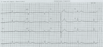 AV Block: 2nd degree, Mobitz II (Hay block) • LITFL • ECG Library
