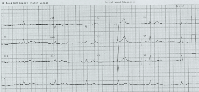 AV Block: 2nd degree, Mobitz II (Hay block) • LITFL • ECG Library