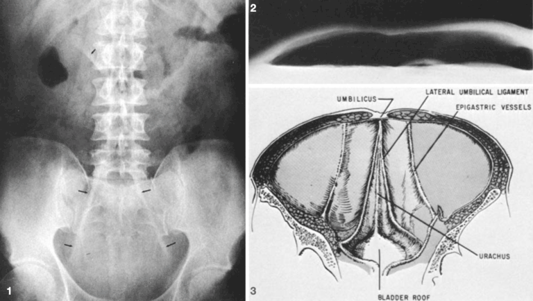 Rigler sign • LITFL • Medical Eponym Library