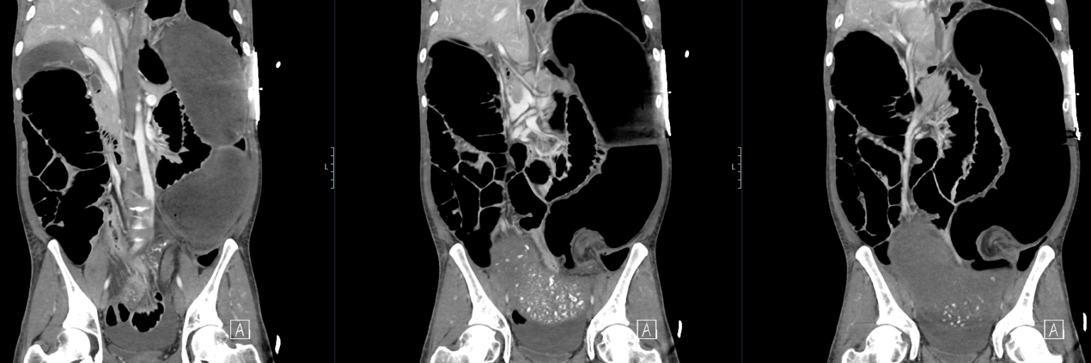CT Case 102 • LITFL • CT scan interpretation